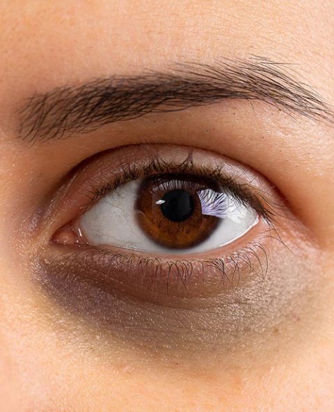 Dark Circles Under Eyes | MGMA